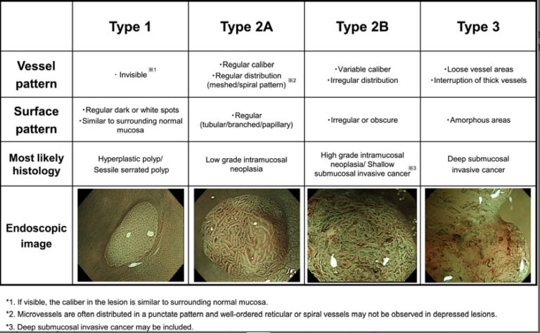 Colonic Polyps – Current Understanding, Implications, Endoscopic ...